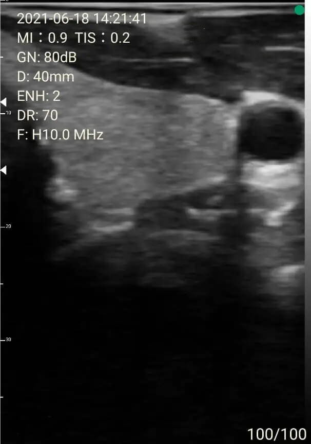 Handheld Ultrasound Review: EagleView Dual-Head Wireless for POCUS