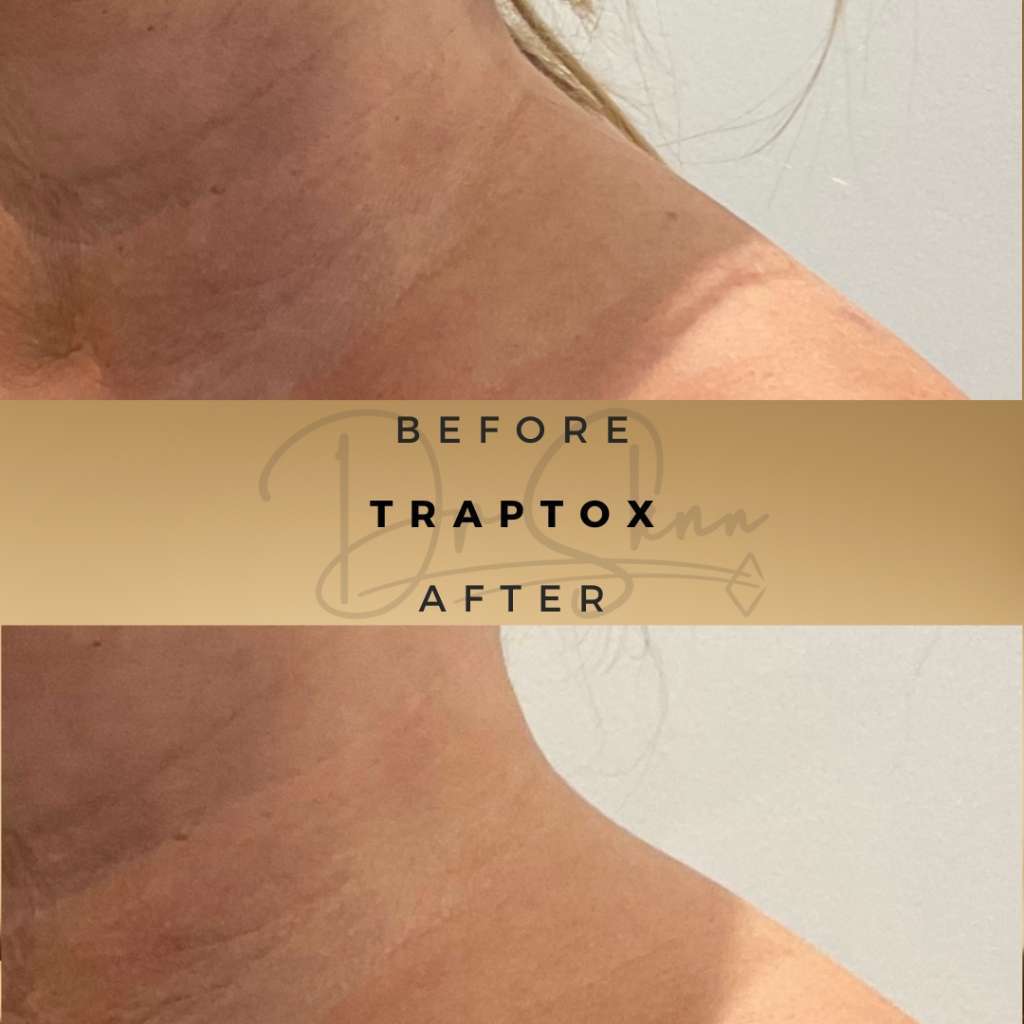 Trapezius Botox | TrapTox | Trap Botox Dr Sknn