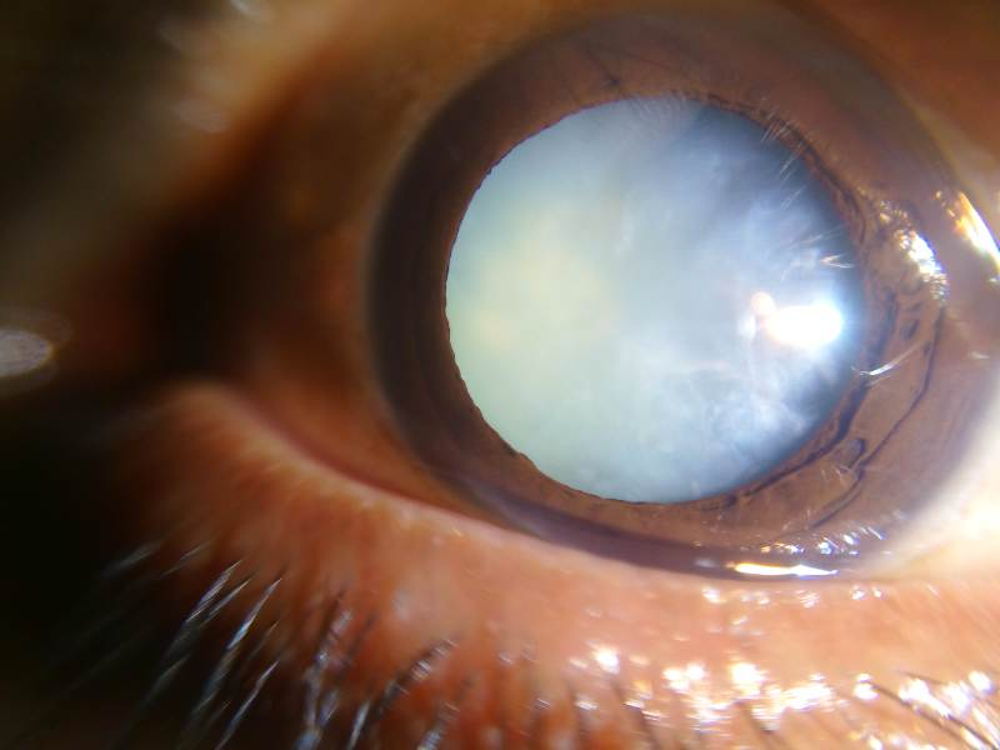 Your Comprehensive Handbook To Learn What Are Cataracts | EyeMountain