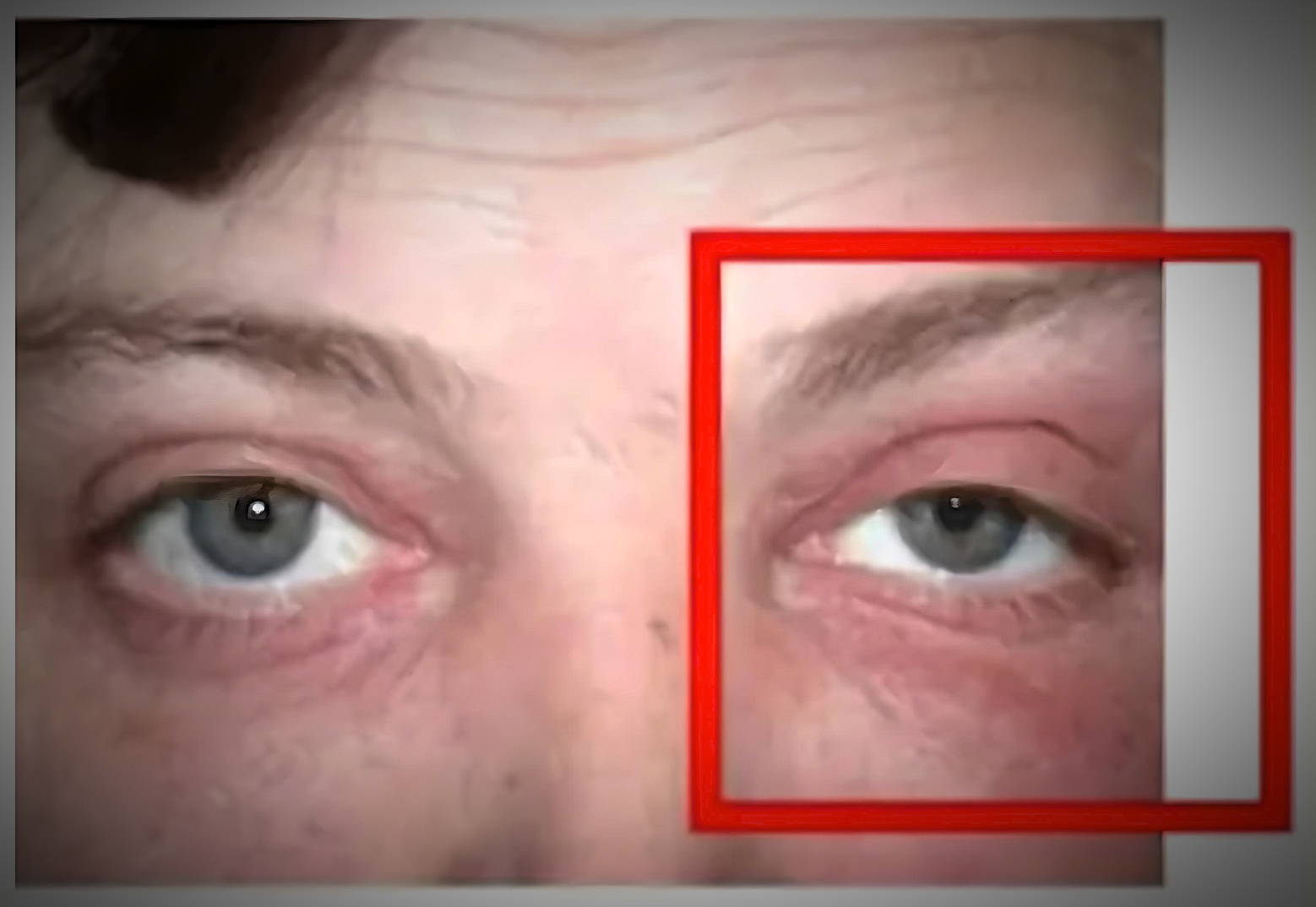 Blepharitis, Sore Dry Eyelids, Eye Dermatitis and Eczema – Natural Elements