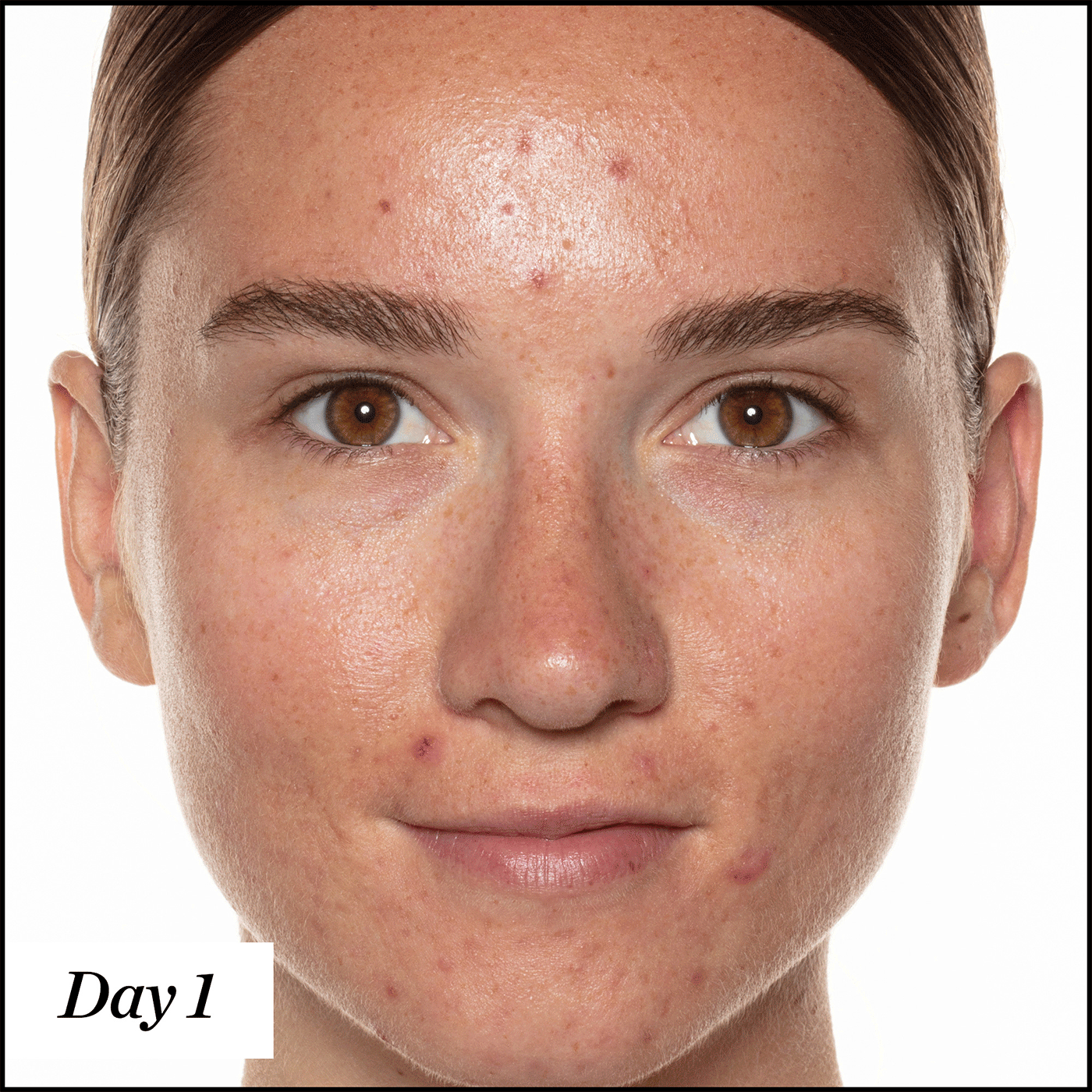 ACNE Sunday Riley