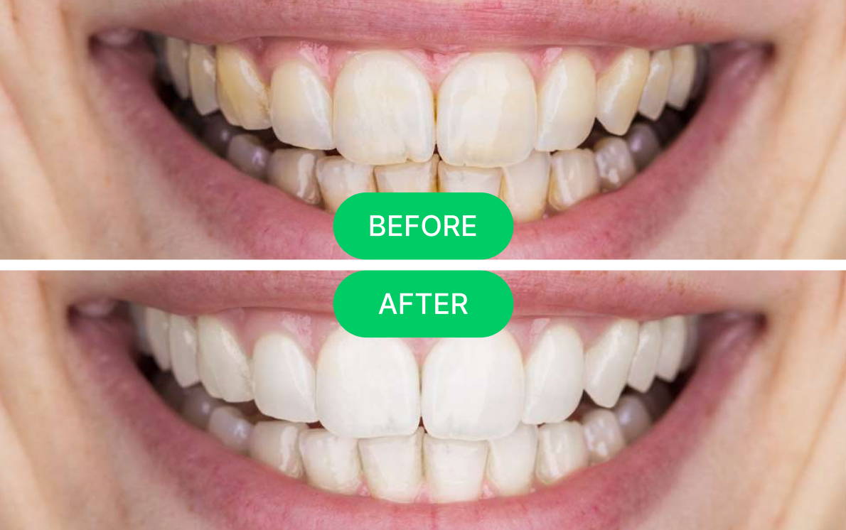 Sonic Tooth Stain Eraser With Plaque Remover Dental Tool – Buy Simple Store