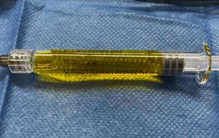 The Complete Walk-through of the Corneal Cross Linking Procedure ...