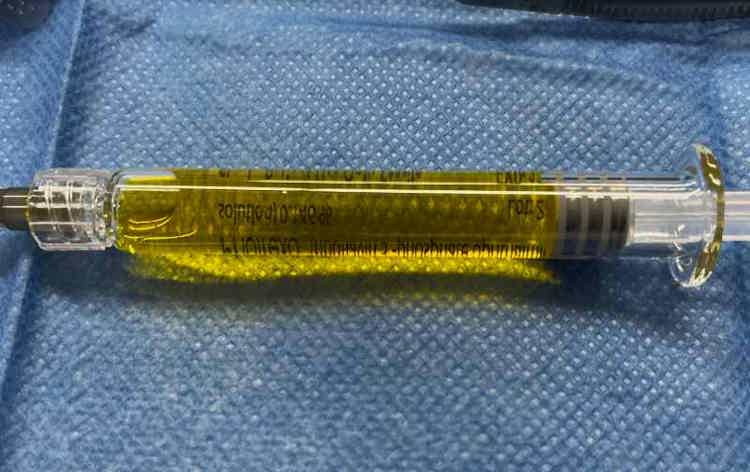 The Complete Walk-through of the Corneal Cross Linking Procedure ...