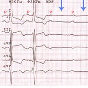AV-блокада II степени высокой градации — Шаг 2 — Stepik