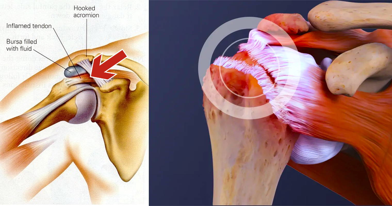 Rotator Cuff Injuries: Understanding Tears, Tendonitis, Symptoms and F ...