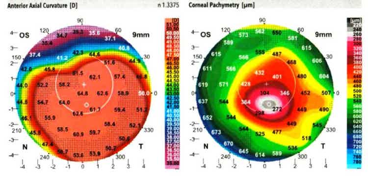 Breaking Down The Stages Of Keratoconus & What You Experience | EyeMountain