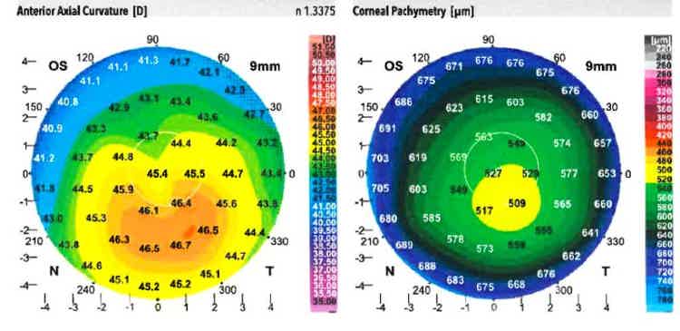 Breaking Down The Stages Of Keratoconus & What You Experience | EyeMountain