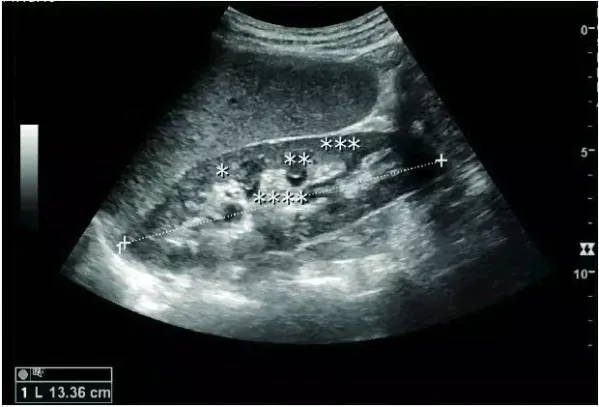 Kidney Ultrasound Images (POCUS): 4 Common Conditions and Scan Tips Us ...