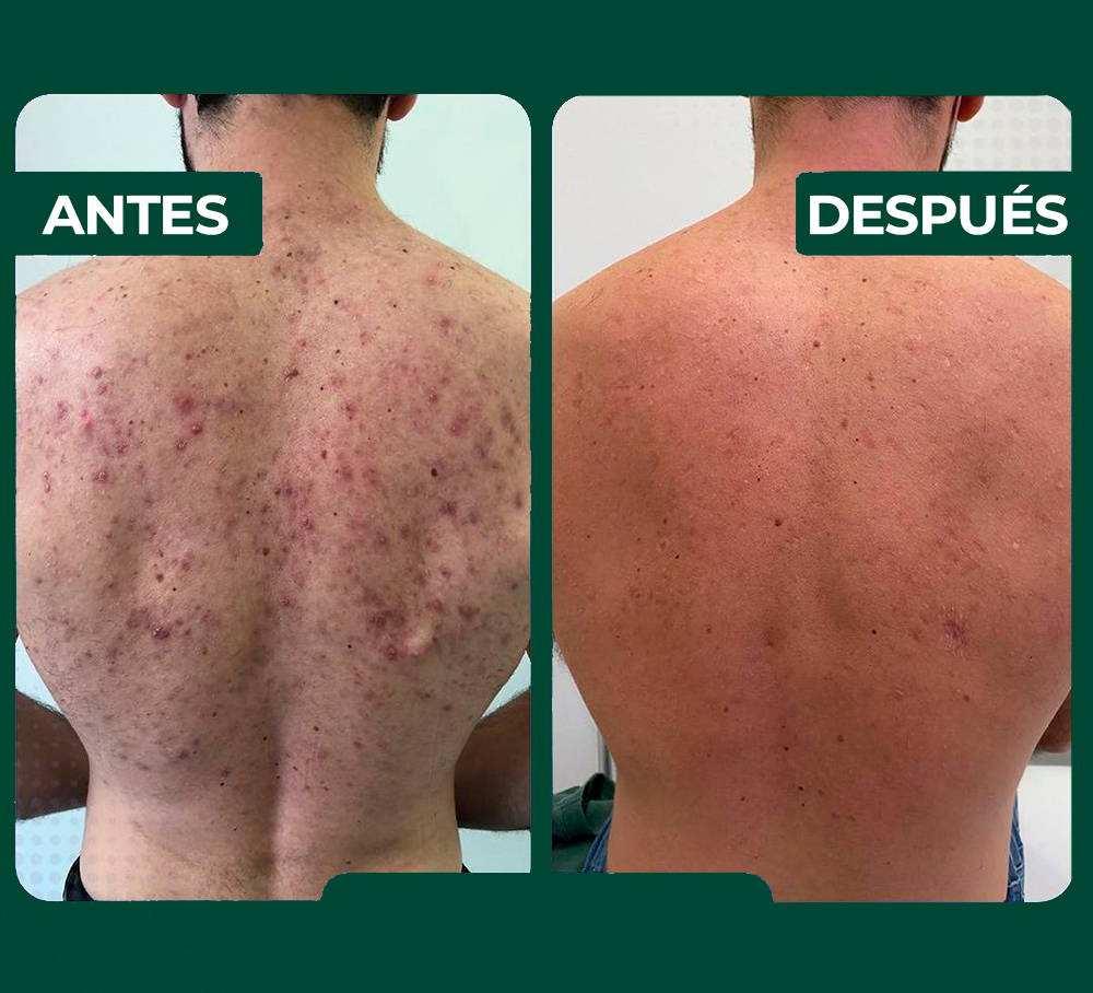 Aerosol para tratamiento en la espalda MEDix – Beauty Secret