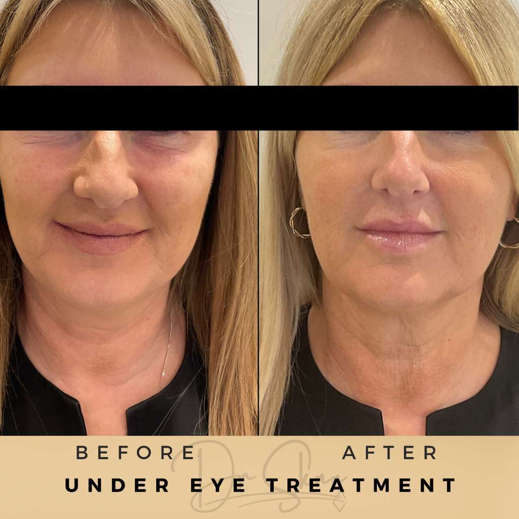 Treatments for Excess Skin Around Eyes | Dr Sknn Wilmslow, Cheshire