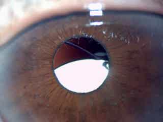 Key Symptoms Of Dislocated Lens After Cataract Surgery | EyeMountain