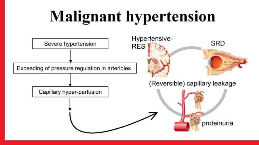 What You Need to Know about Malignant Hypertension Checkme