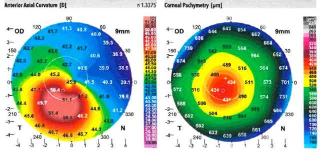 Breaking Down The Stages Of Keratoconus & What You Experience | EyeMountain