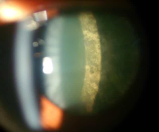 Here’s How To Get Rid Of Cataract Glare | EyeMountain