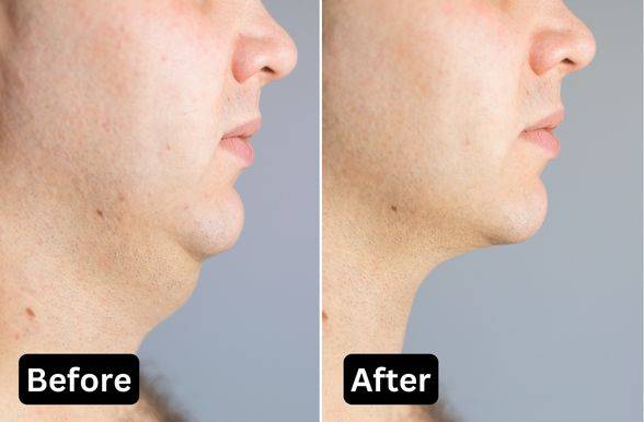 JawCuts - Jaw muscle growth technology.