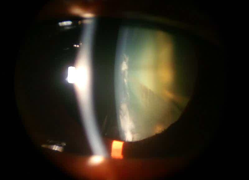 Here’s How To Get Rid Of Cataract Glare | EyeMountain