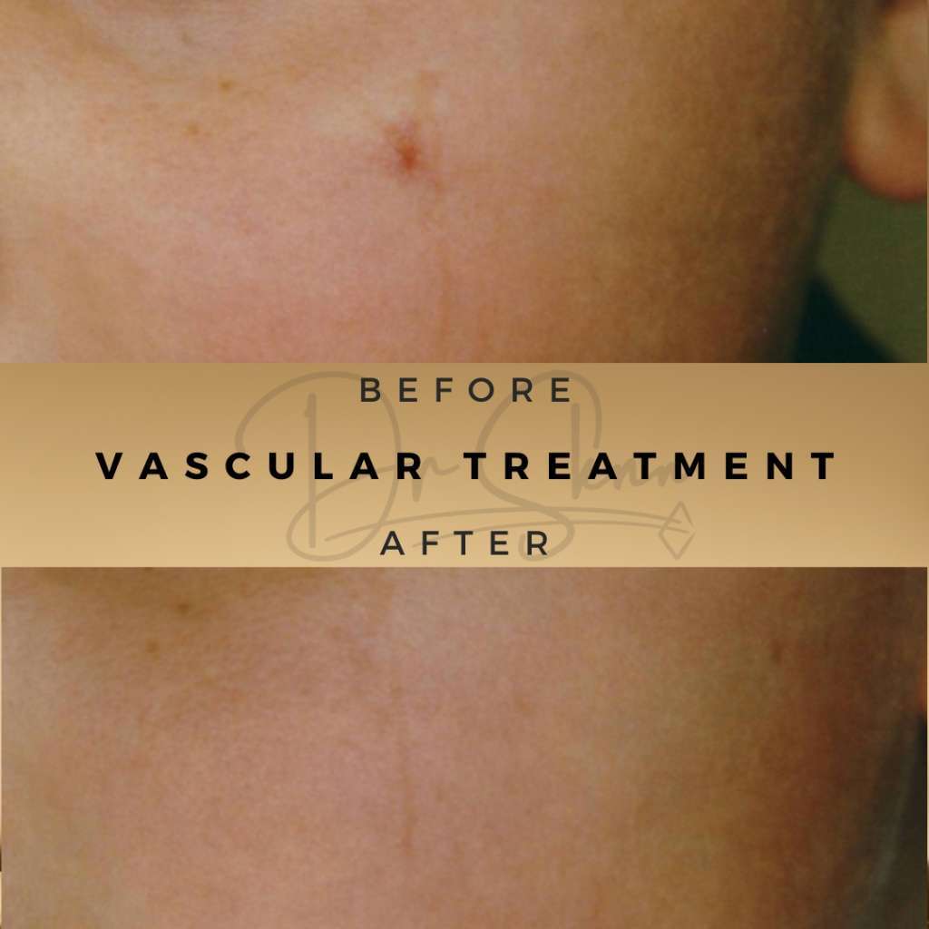 Spider Nevi | Spider Nevus Treatment at Dr Sknn