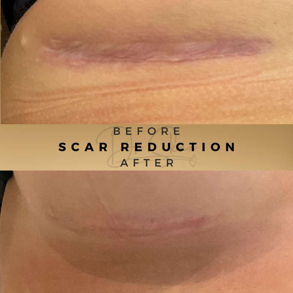 Expert Keloid Scar Treatment Dr Sknn | Doctor Led Keloid Scar Removal