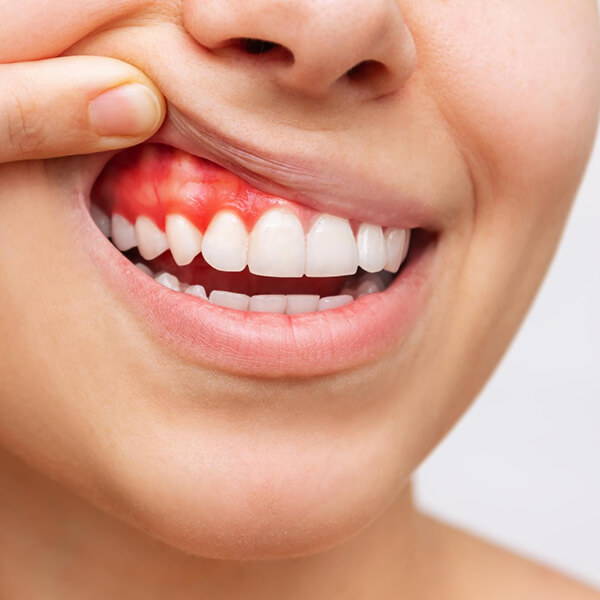 Heal Periodontal Treatment and Receding Gums - Novaa Oral Care Pro ...