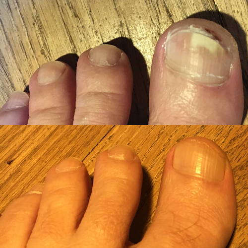 Happy Nails | The Nail Fungus Treatment that brings Results – Happy ...