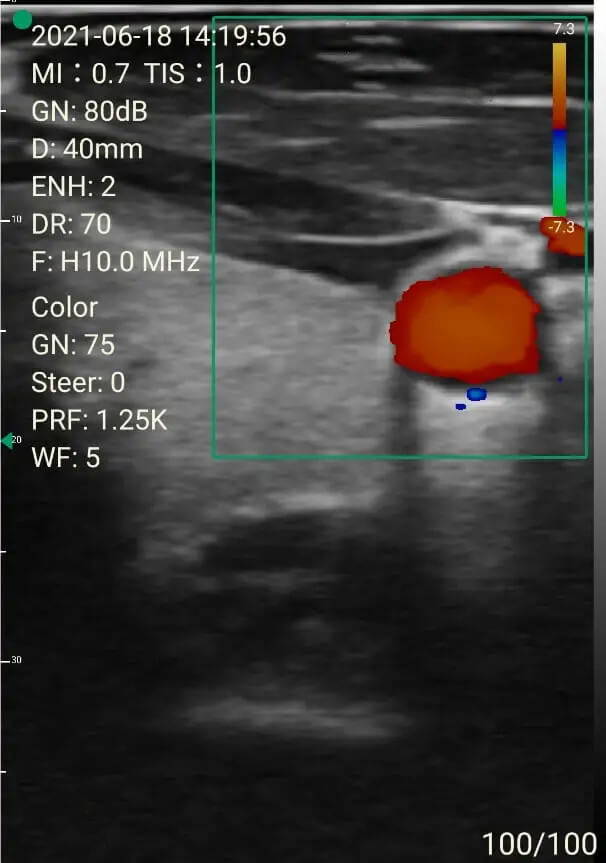 Handheld Ultrasound Review: EagleView Dual-Head Wireless for POCUS