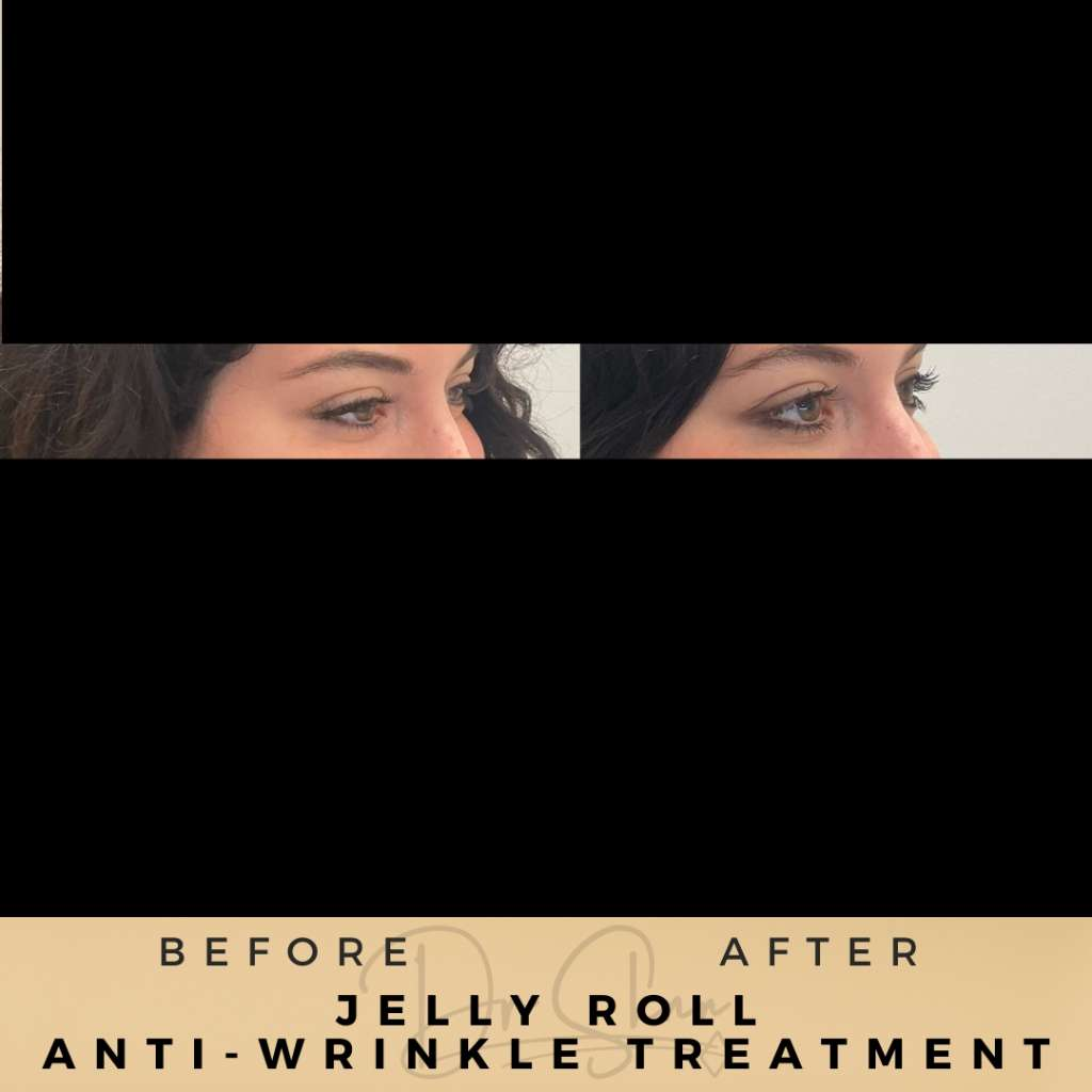 Under Eye Puffiness Treatments at Dr Sknn