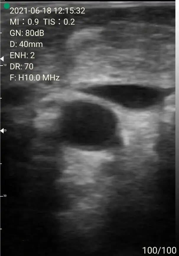 Handheld Ultrasound Review: EagleView Dual-Head Wireless for POCUS